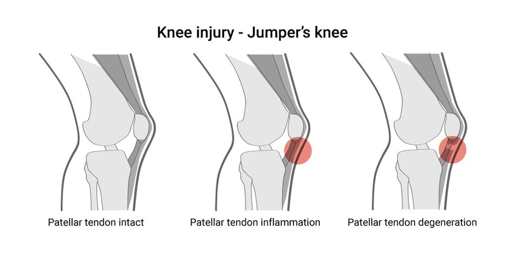 Knee Tendonitis