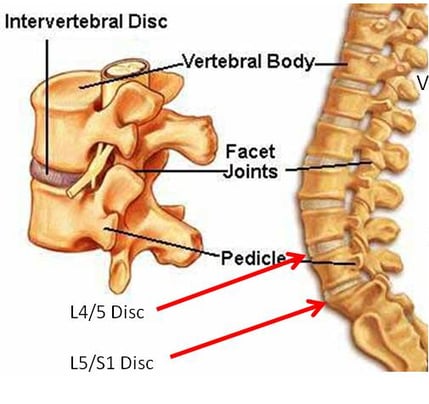 Low Back Pain